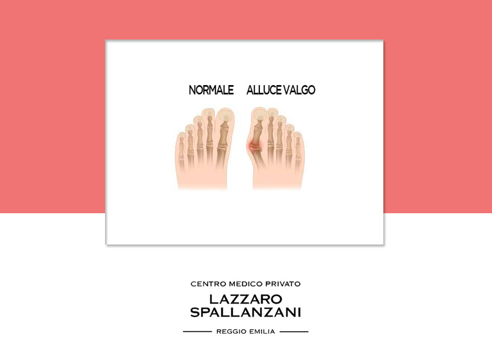 Rimedi contro l’ alluce valgo: l’efficacia limitata dei tutori - CMLS